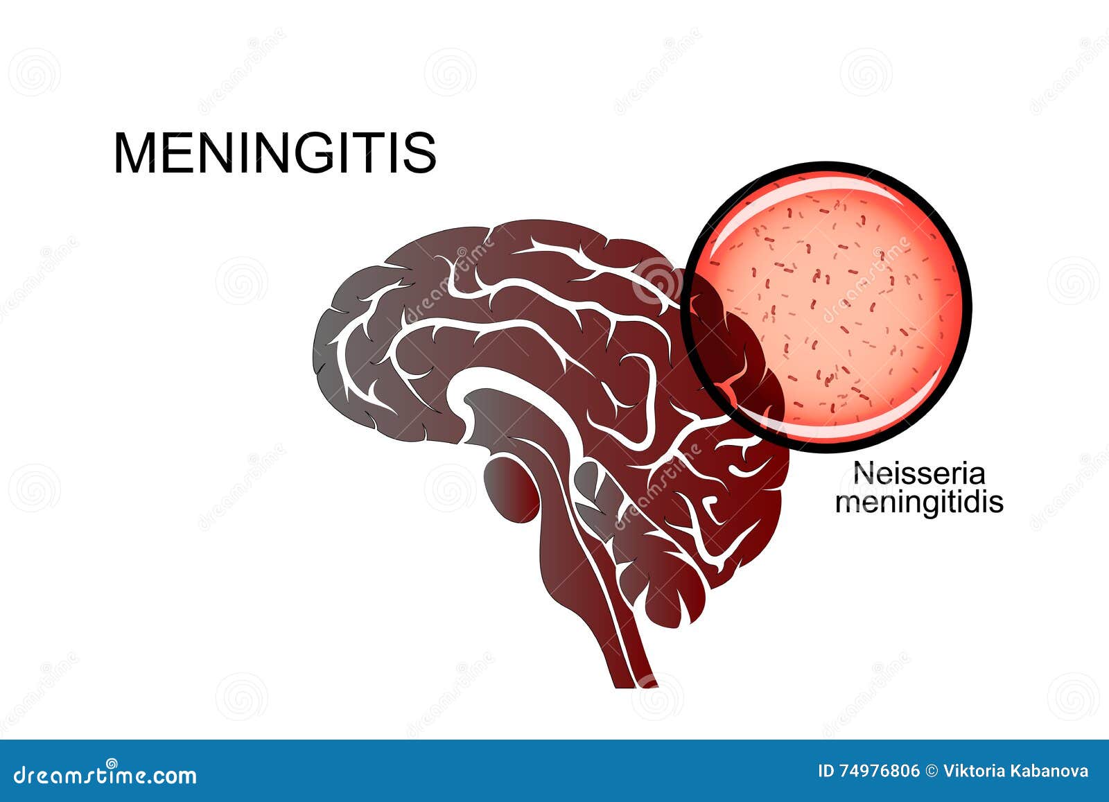 Meningitis Cartoons Illustrations And Vector Stock Images 80 Pictures To Download From