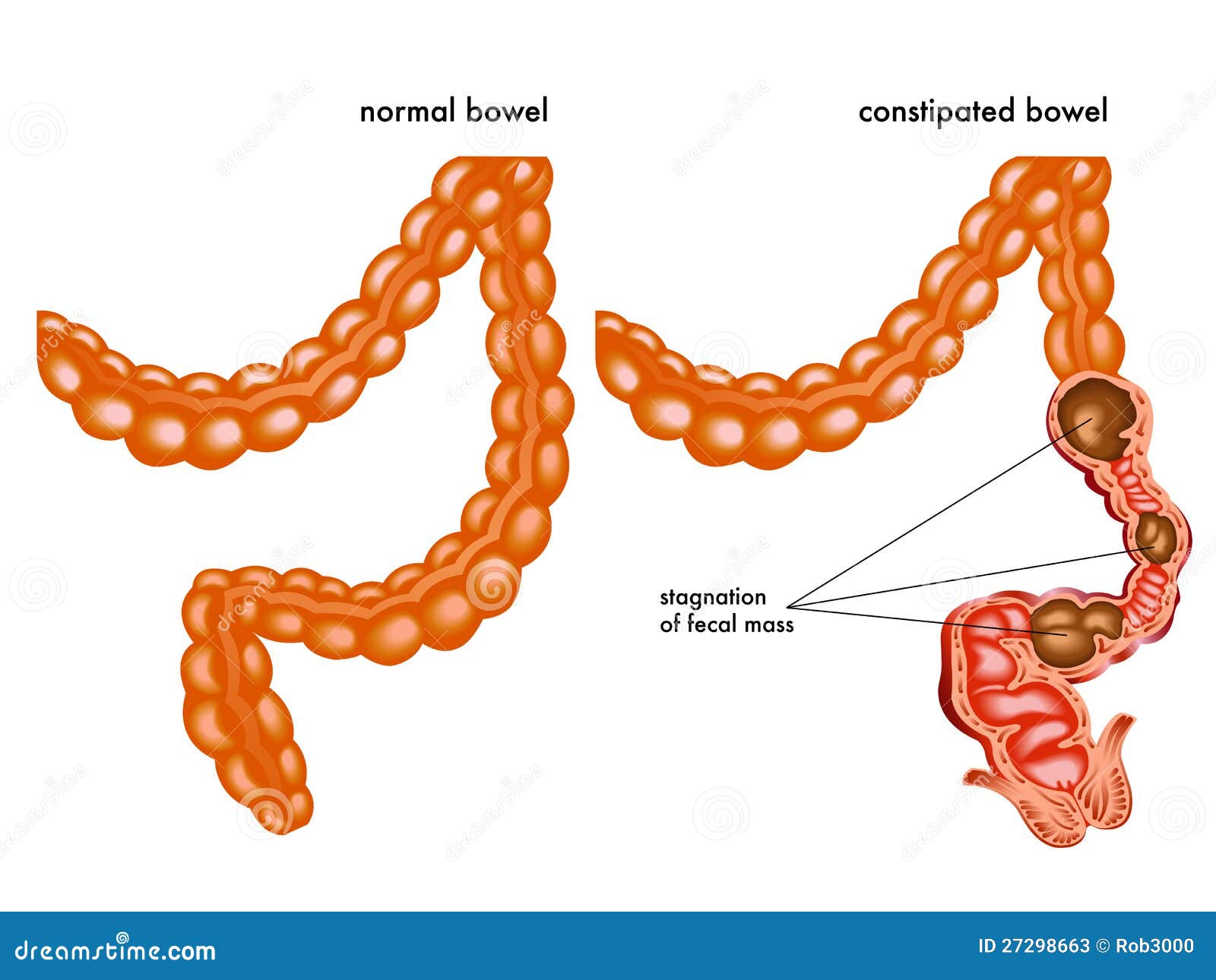 Constipation Stock Photos - Image: 27298663 Constipation Stock Photos - Image: 27298663