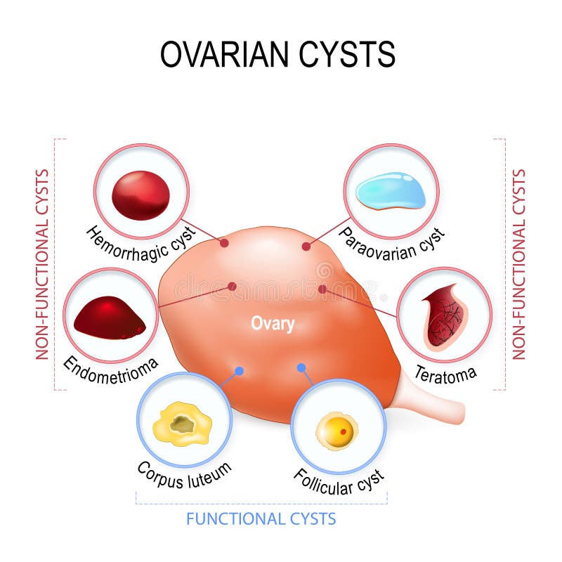 Hemorrhagic Cysta På äggstocken Ovary Infographics Illustration Stock ...