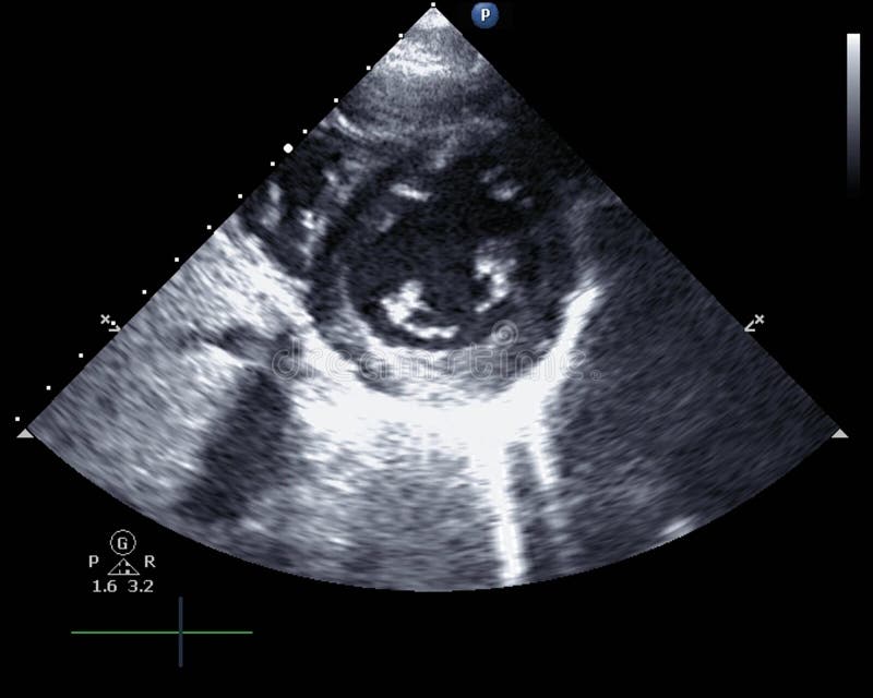 Échocardiogramme image stock. Image du gauche, quantification - 52730639