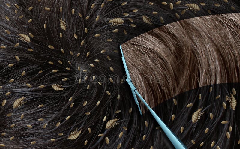 Élimination des poux illustration stock. Illustration du insectes ...