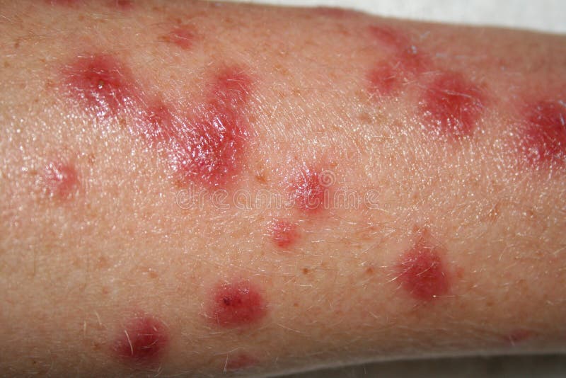éruption Cutanée Photos Stock - Téléchargez 263 Photos libres de droits