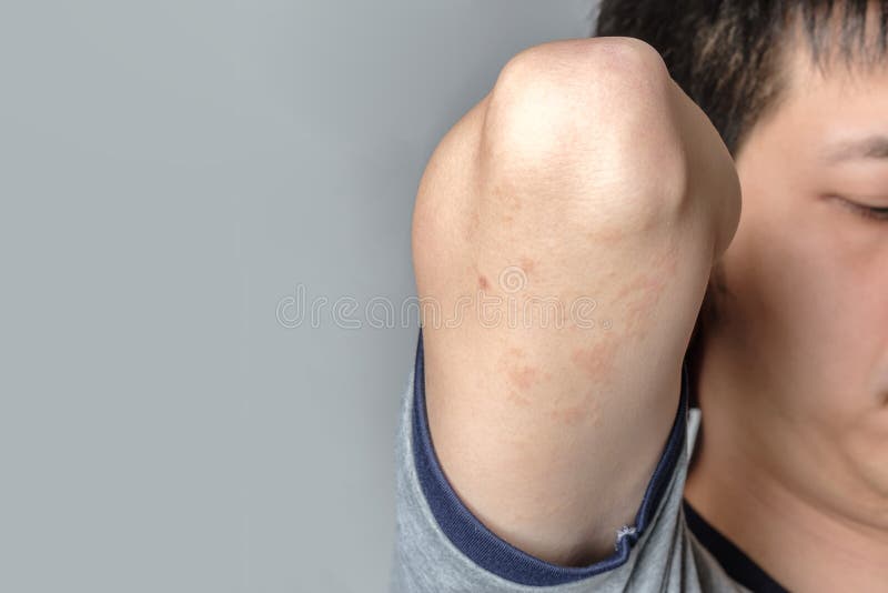 Psoriasis Sur Le Bras Photos Stock - Téléchargez 194 Photos libres de ...