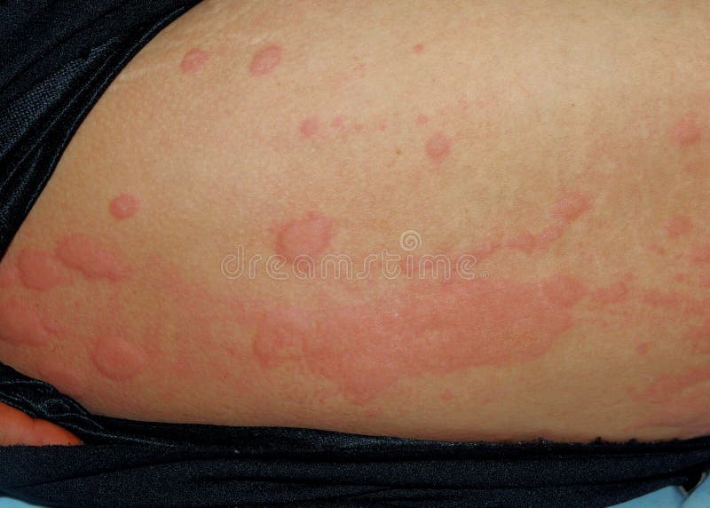 Éruption d'Urticaria photo stock. Image du médical, réaction - 121957480