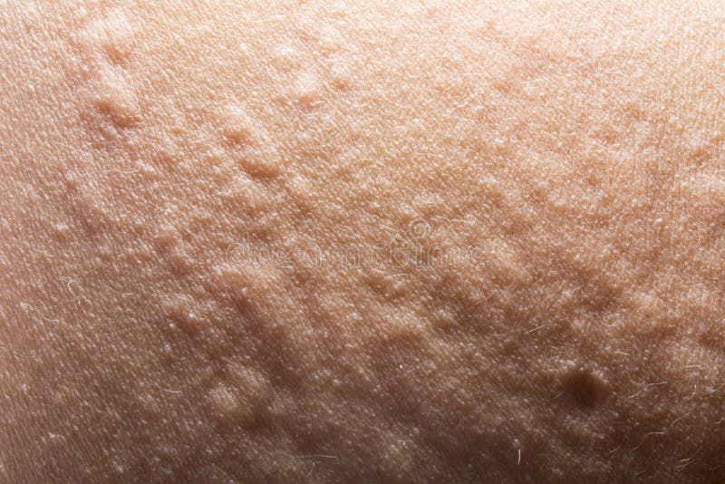 Éruption Cutanée, Urticaria, Réaction Allergique De Peau Image stock ...