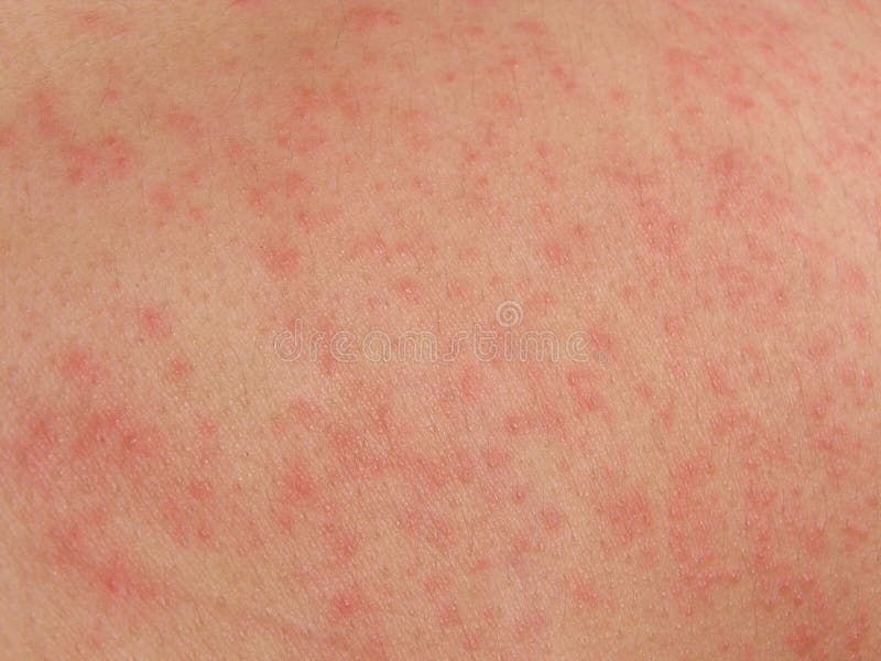 La Grande Tache Rouge Sur Le Plan Rapproché De Peau Photo stock - Image ...