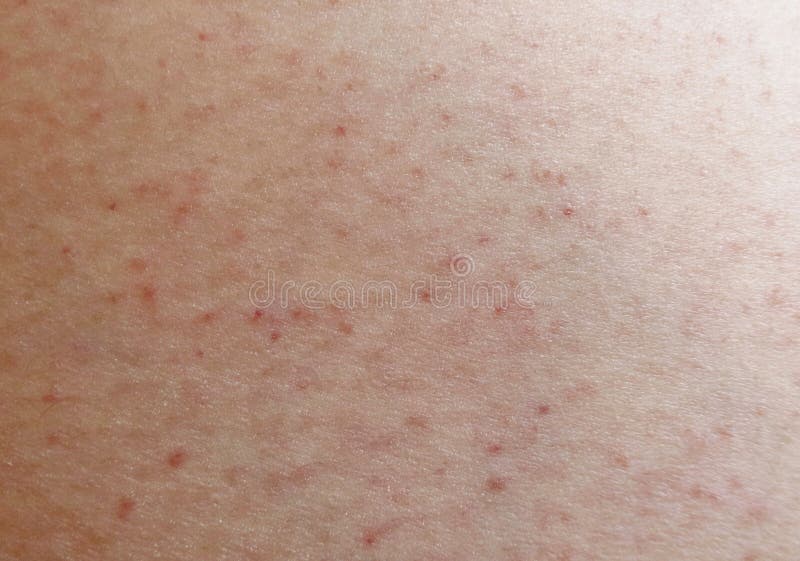 Bouton Sur La Peau Photos Stock - Téléchargez 2,941 Photos libres de droits