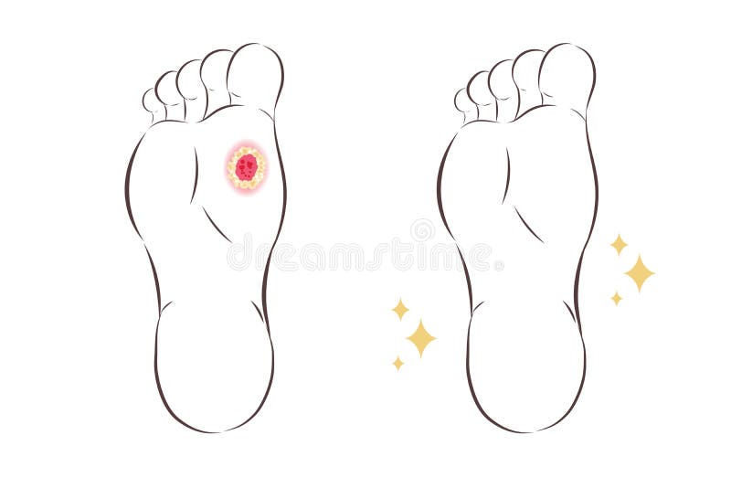 Úlceras en el pie stock de ilustración. Ilustración de diabetes - 131255492