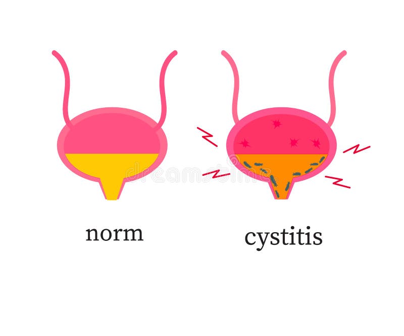Cystitis Infection Stock Illustrations – 393 Cystitis Infection Stock ...