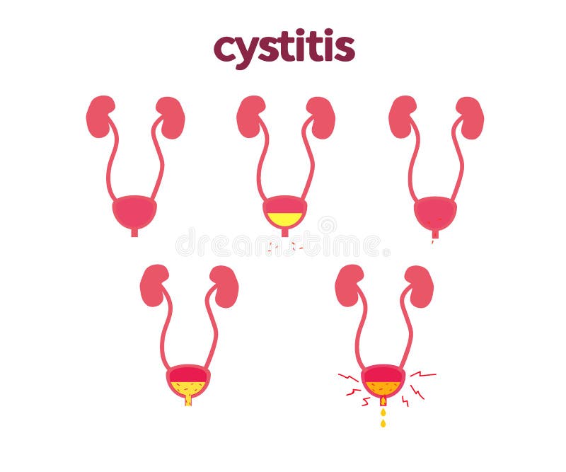 Sick Bladder on a White Background. Cystitis. Symbol Stock Vector ...