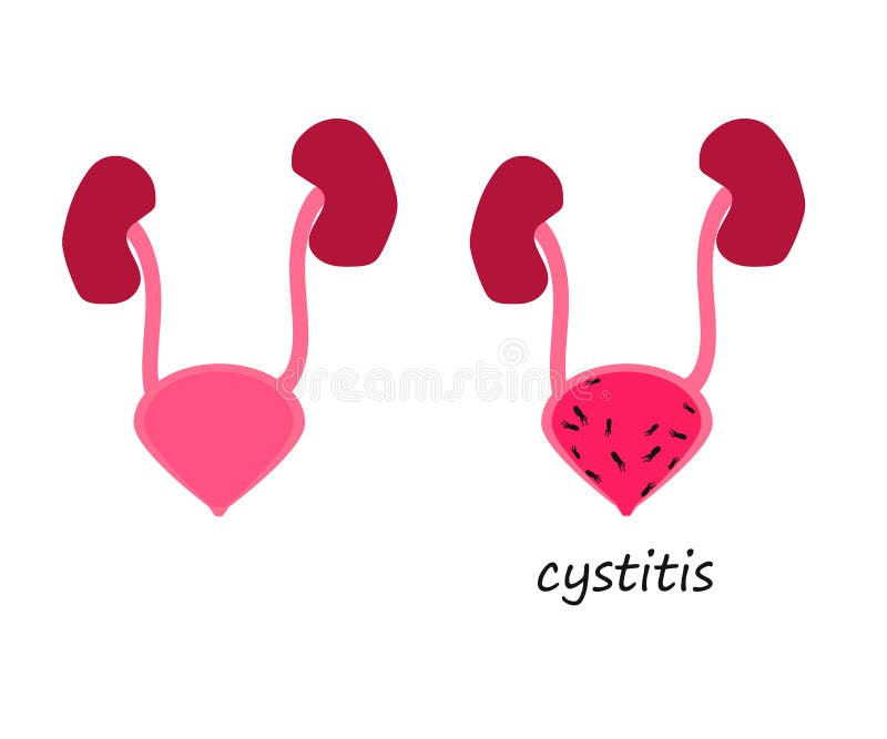 Bladder Bacteria Stock Illustrations – 243 Bladder Bacteria Stock ...