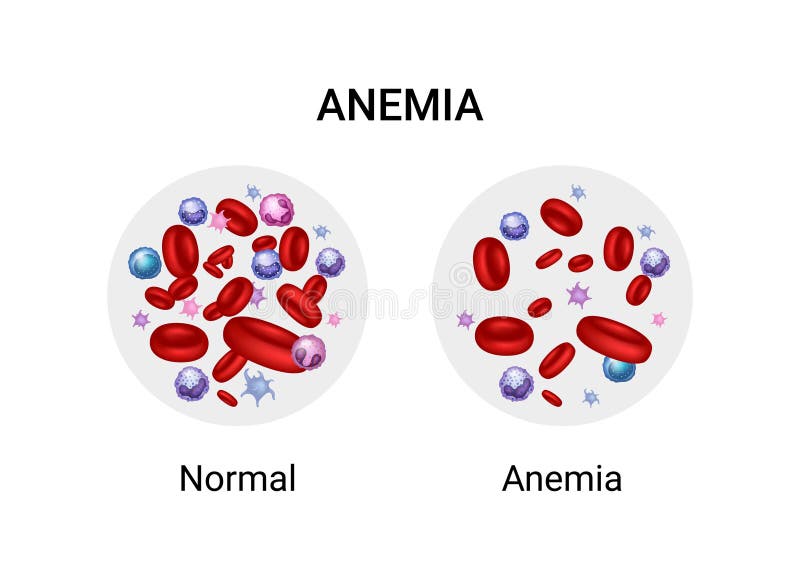 Anemia Diagram Stock Illustrations – 312 Anemia Diagram Stock ...