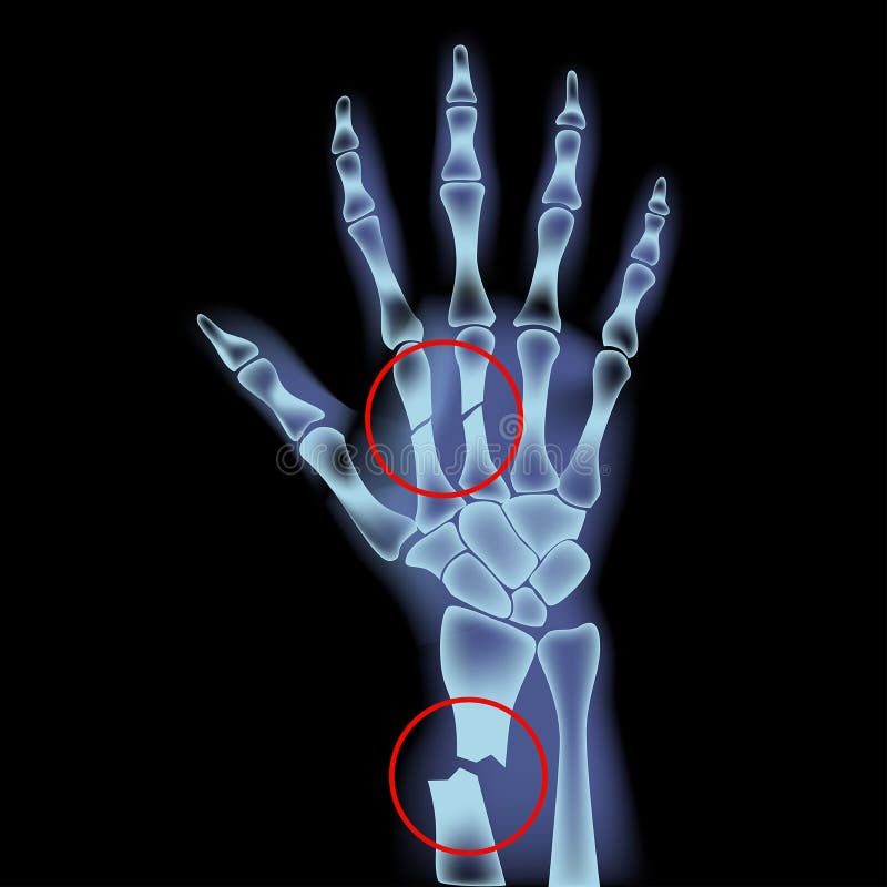 Fracture Metacarpal Stock Illustrations – 62 Fracture Metacarpal Stock ...