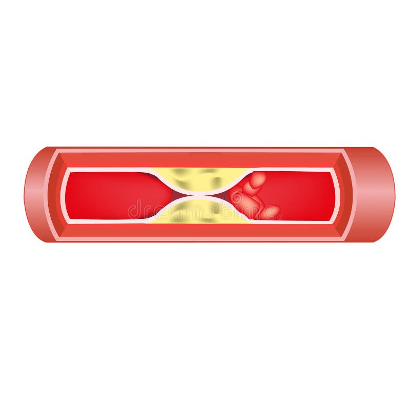The Structure of the Human Artery. the Formation of Fatty Plaques and ...