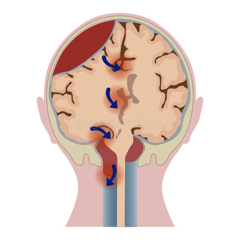 Brain Hematoma with Tissue Distortion. Stock Vector - Illustration of ...