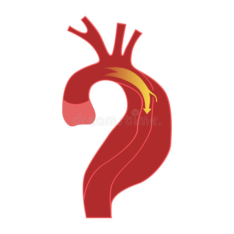 Aortic Dissection, Dissecting Aneurysm. Stock Vector - Illustration of ...