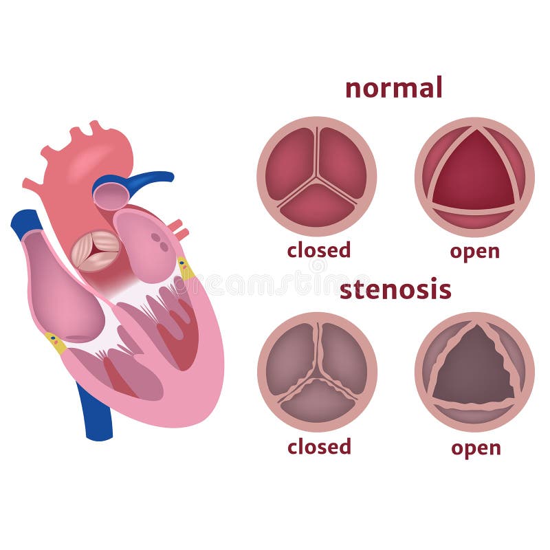 Aortic Insufficiency Stock Illustrations – 12 Aortic Insufficiency ...