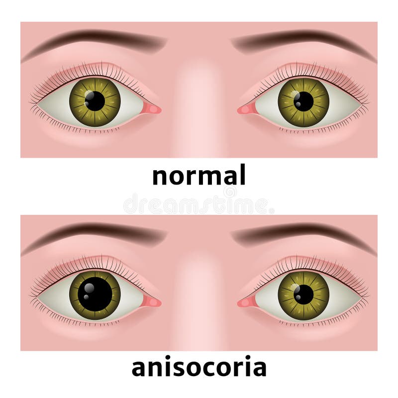 Anisocoria. Abnormally Dilated Pupil of the Eye Stock Vector ...