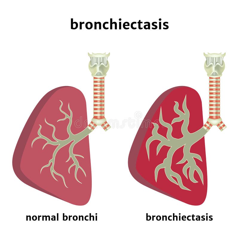 Bronchiectasis Stock Illustrations – 178 Bronchiectasis Stock ...