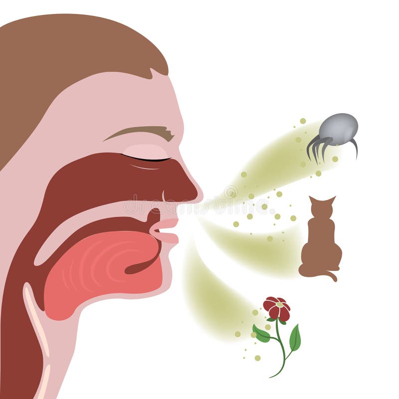 Allergic Rhinitis. Infographic of Head with Respiratory Tract Stock ...