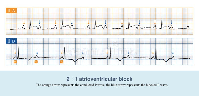 Atrioventricular Block Stock Photos - Free & Royalty-Free Stock Photos ...