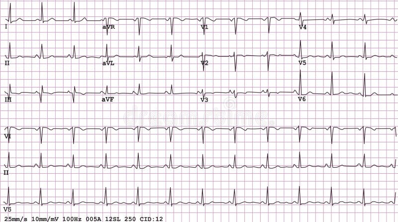 Elektrokardiogram ilustracji. Ilustracja złożonej z elektrokardiogram ...