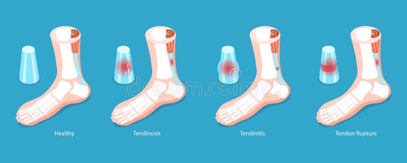 Achilles Tendon Rupture Stock Illustrations – 51 Achilles Tendon ...