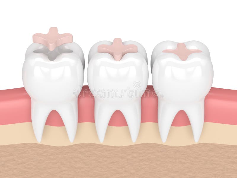 Dental Restoration 3d Render Stock Illustrations – 1,214 Dental ...
