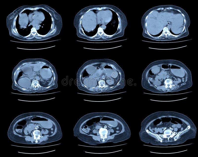 Scanner D'un Abdomen Suggérant Le Diagnostic D'une Appendicite Aiguë ...