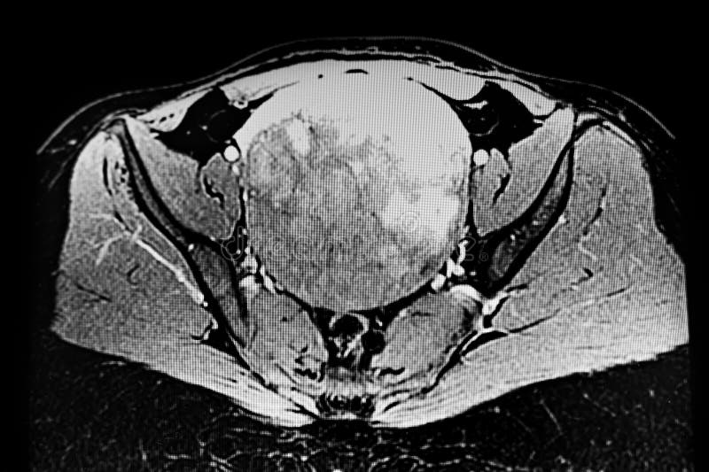 Abdomen Pelvic Ct Scan Showing Uterine Tumor Leiomyoma Stock Image