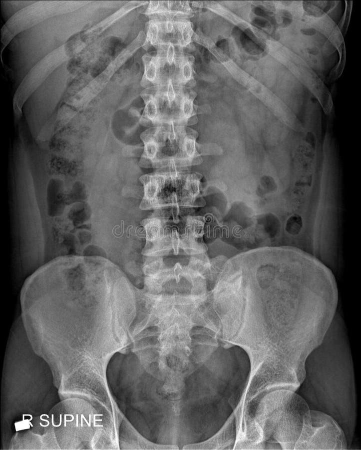 Abdomen Radiograph Showing Bowel Obstruction Stock Photo - Image of ...