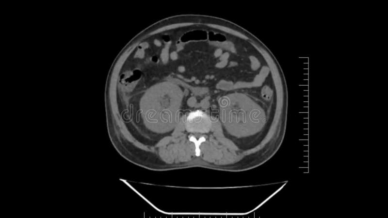 Abdominal CT Scan or Abdomen Mri Stock Footage - Video of anatomy ...
