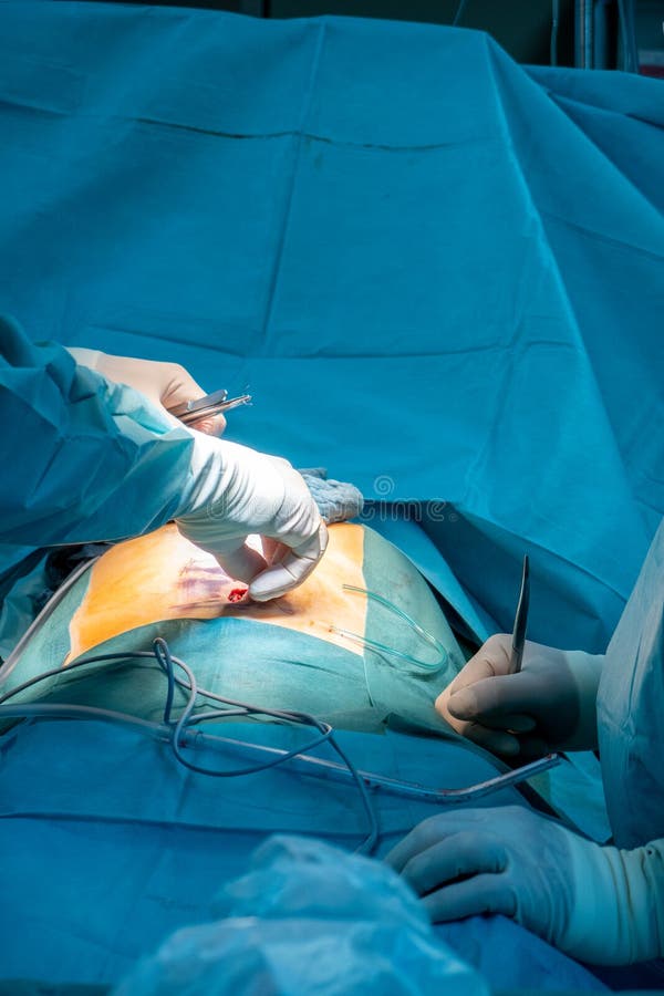 Abdominal Operation is Performed in an Operating Room Stock Photo ...