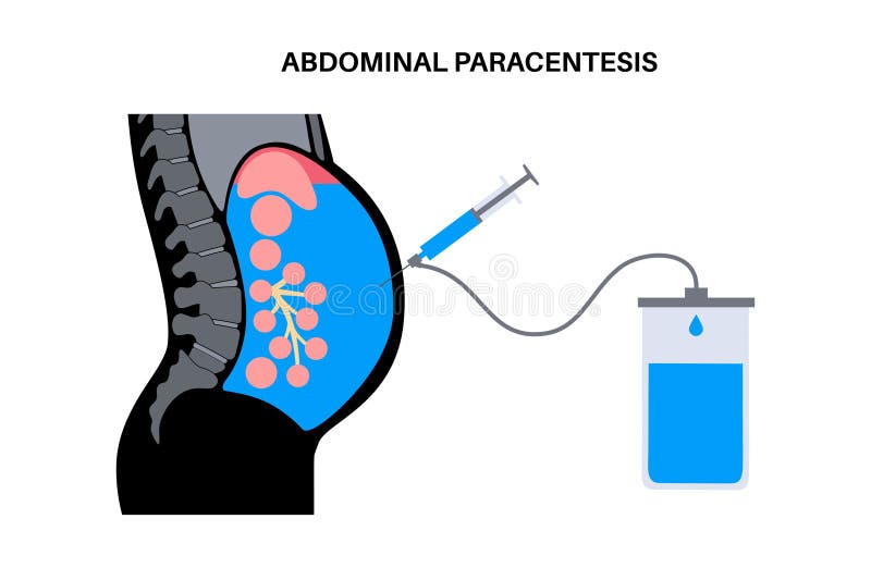 Abdominal Paracentesis Poster Stock Vector - Illustration of peritoneum ...