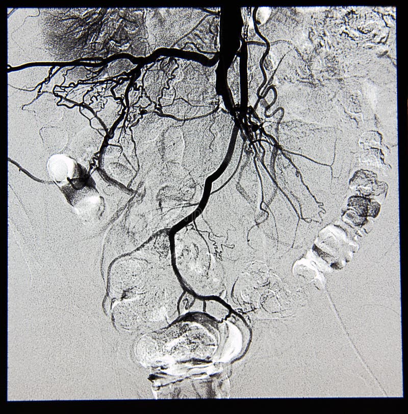 Abdominal and Pelvic Angiography, Vessels Stock Image - Image of ...