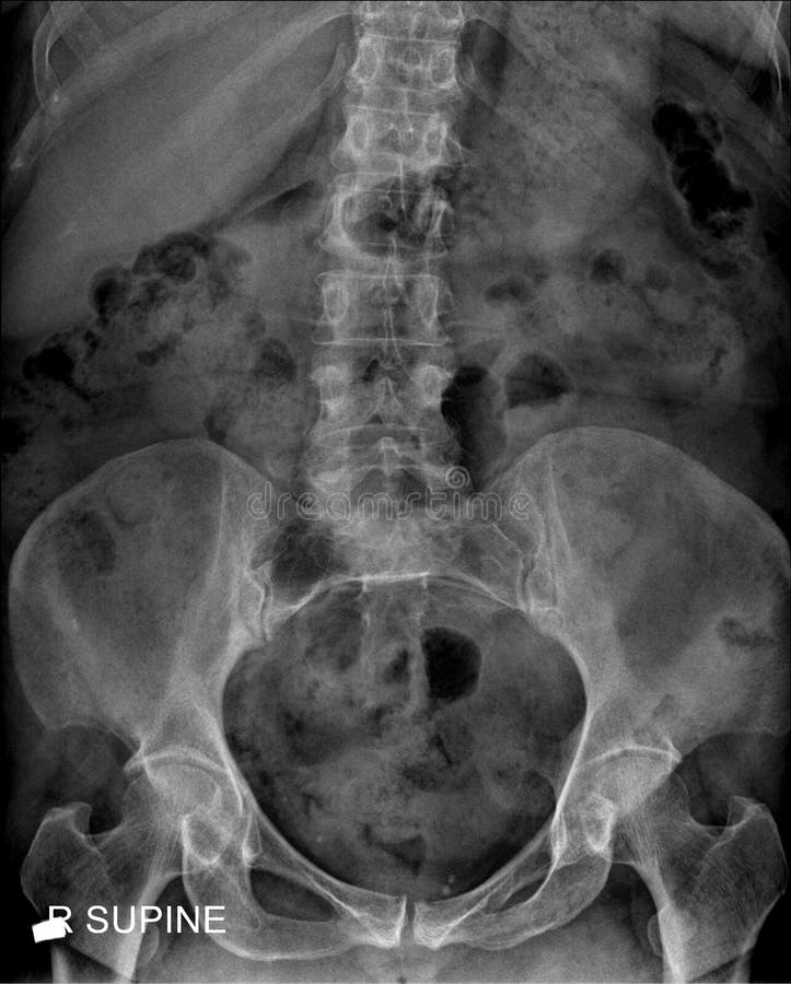 Abdominal X-ray in Supine Position for Medical Evaluation Stock Photo ...