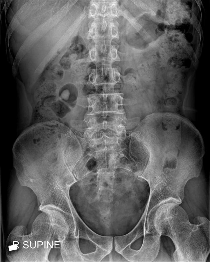 Abdominal X-ray in Supine Position for Medical Evaluation Stock Photo ...