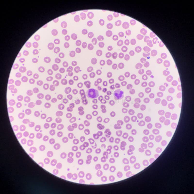 Abnormal Neutrophil In Blood Smear. Stock Image - Image of blood ...