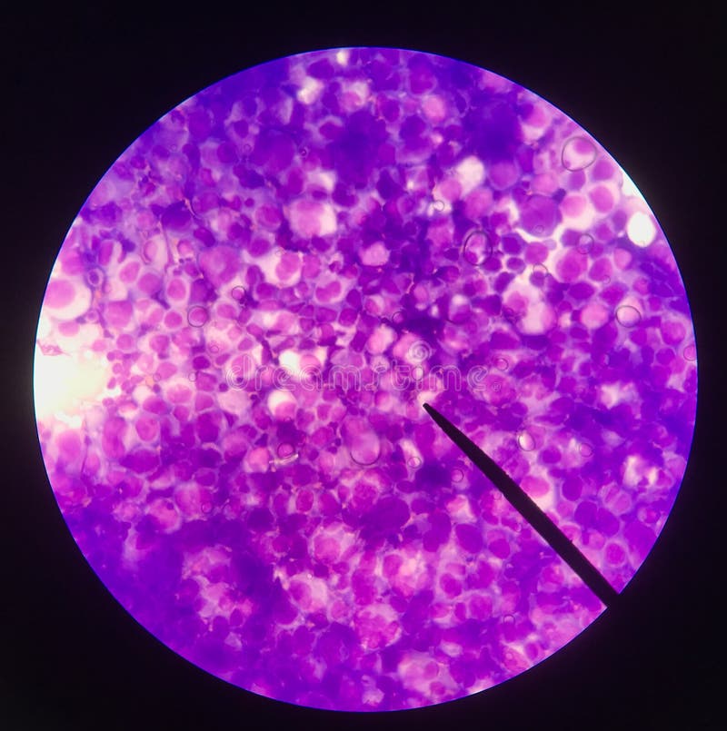 Abnormal Cell Blood Smear Science Concept Stock Photo - Image of ...