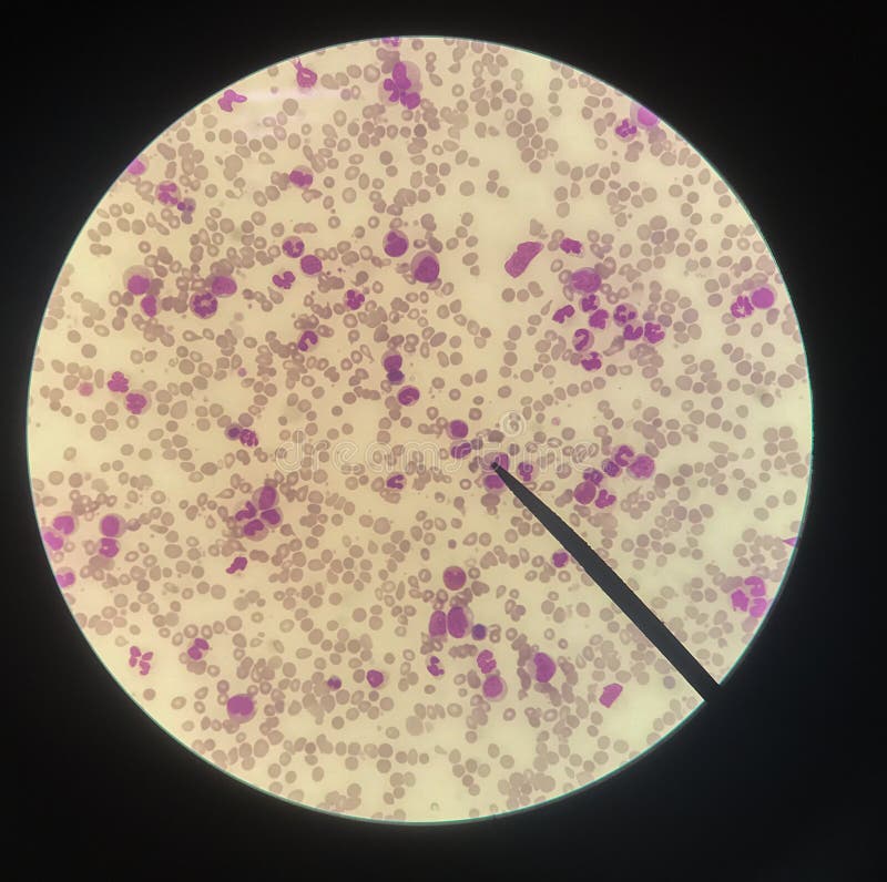 Abnormal Cell Blood Smear Science Concept Stock Image - Image of ...