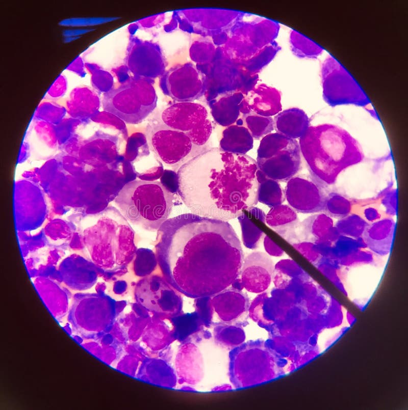 Abnormal Cell Blood Smear Science Concept Stock Image - Image of ...