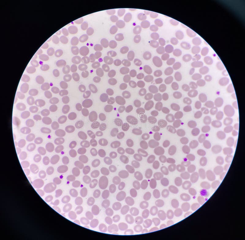 Abnormal Cell Macro Ovalocyte Stock Image - Image of health, plasma ...
