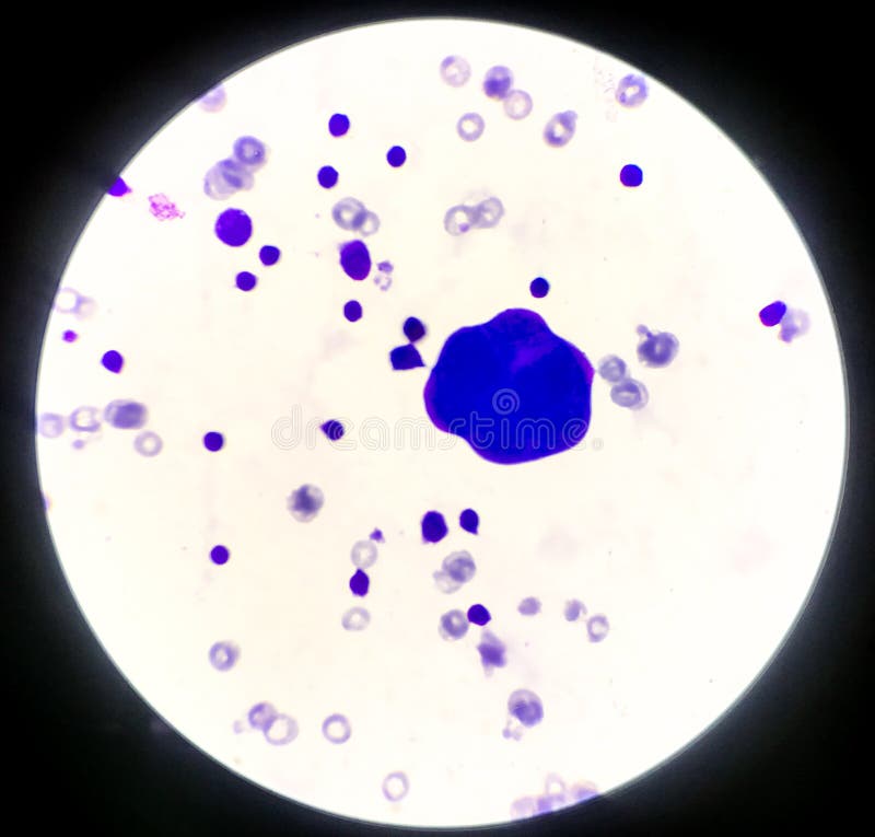 Abnormal Cells in Pleural Fluid Stock Image - Image of abstract, cells ...