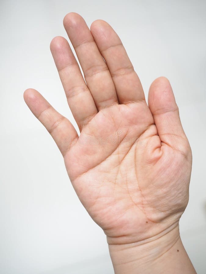Abnormal Finger Alignment Due To Accident Stock Image - Image of pinky ...