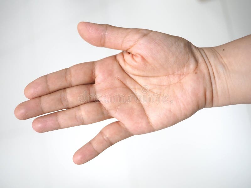 Abnormal Finger Alignment Due To Accident Stock Photo - Image of ...