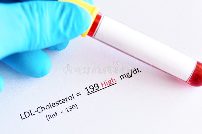 Abnormal High LDL-cholesterol Test Result Stock Image - Image of ...