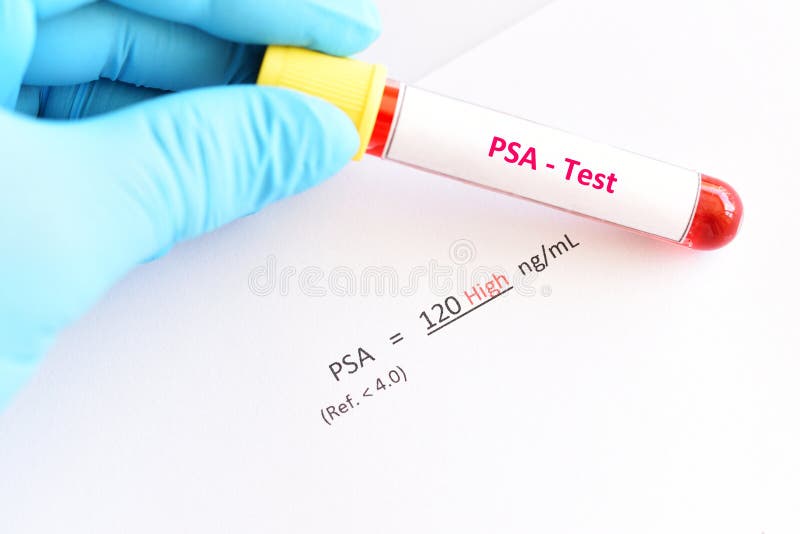 Abnormal High PSA Test Result Stock Image - Image of abnormal, disease ...