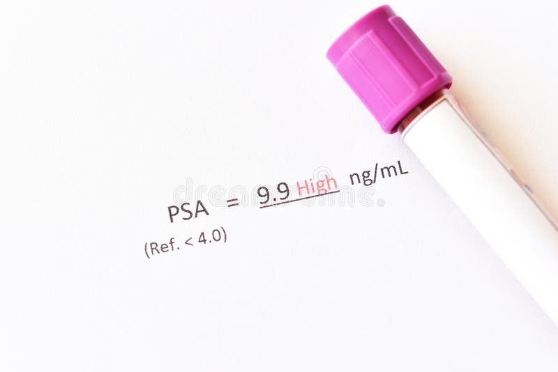 Abnormal High PSA Test Result Stock Image - Image of cancer, immunology ...