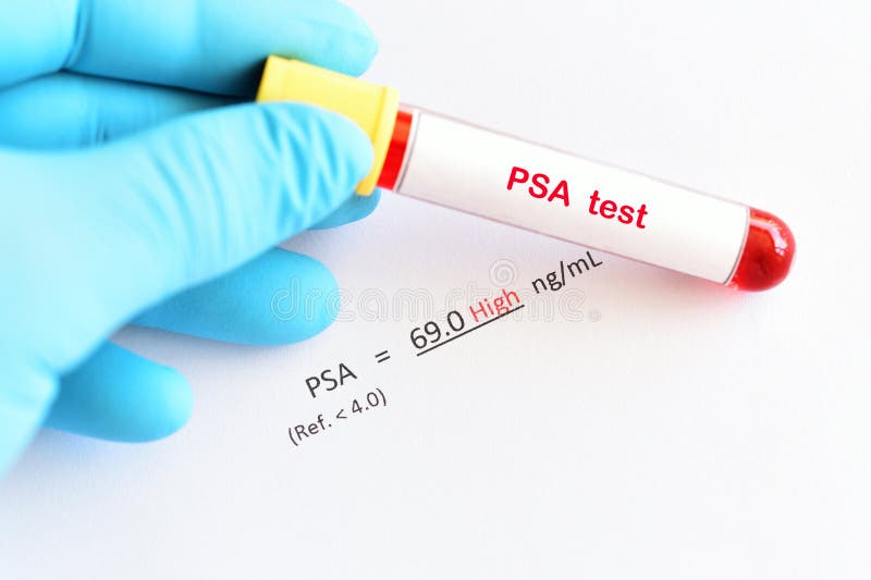 Abnormal High PSA Test Result Stock Image - Image of disease, chronic ...