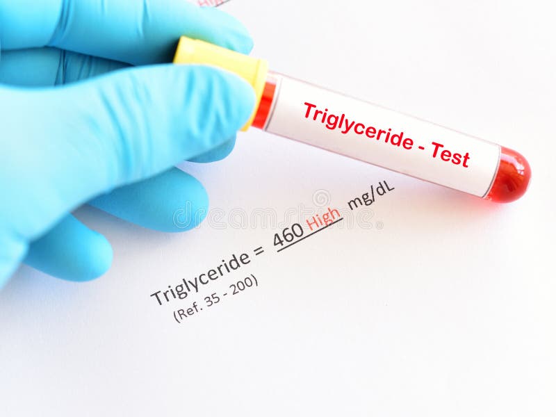 Abnormal High Triglyceride Result Stock Image - Image of lipoprotein ...